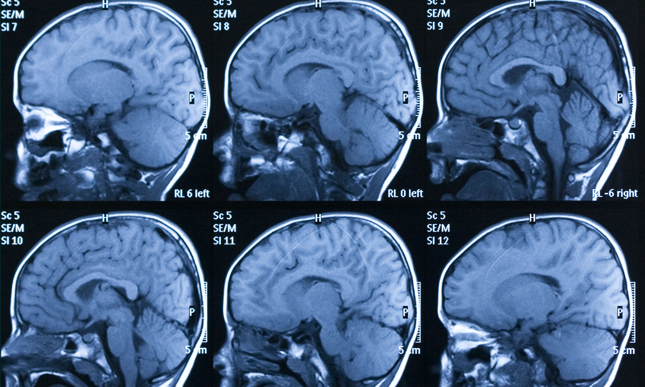 Brain Scans Of Premature Babies Reveal Changes That May Raise Risk Of Brain Scans Of Premature Babies Reveal Changes That May Raise Risk Of